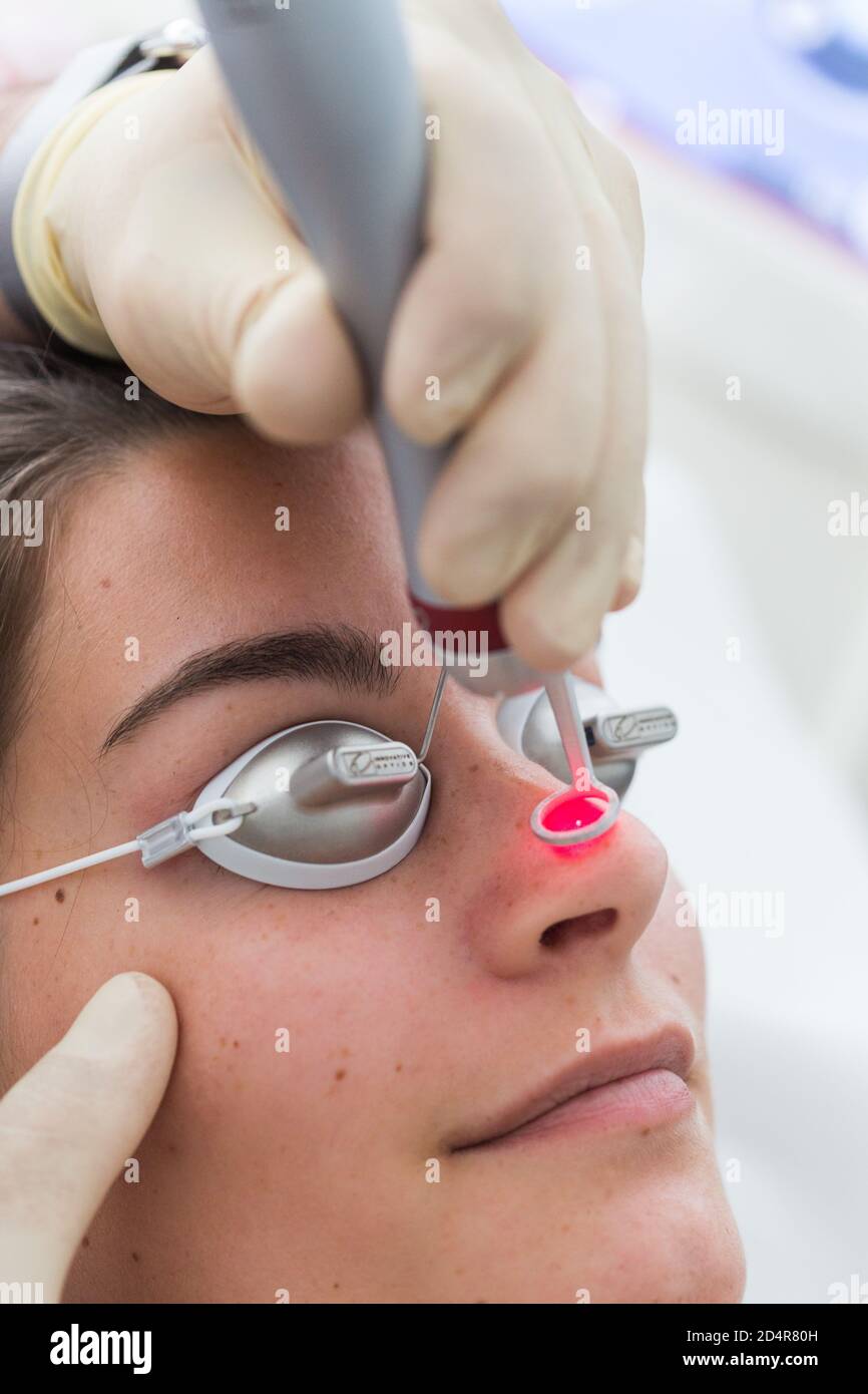 Vascular laser used in treatment of rosacea and varicosity Stock Photo ...