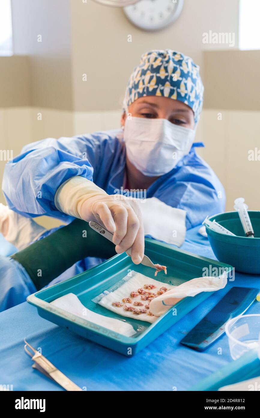 Micrografting hair follicle extraction, FUE Follicular Unit Extraction ...