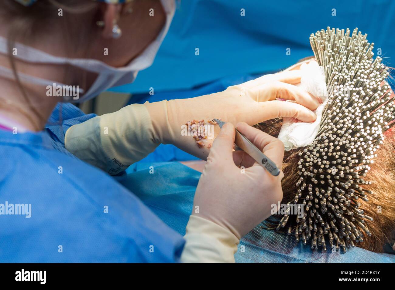Fue Follicular Unit Extraction Homehospice