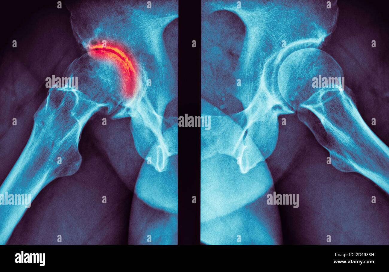 X-ray showing arthritis of the hip, arthritis is a joint disease that ...