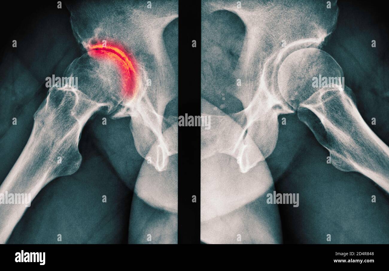 X-ray showing arthritis of the hip, arthritis is a joint disease that ...