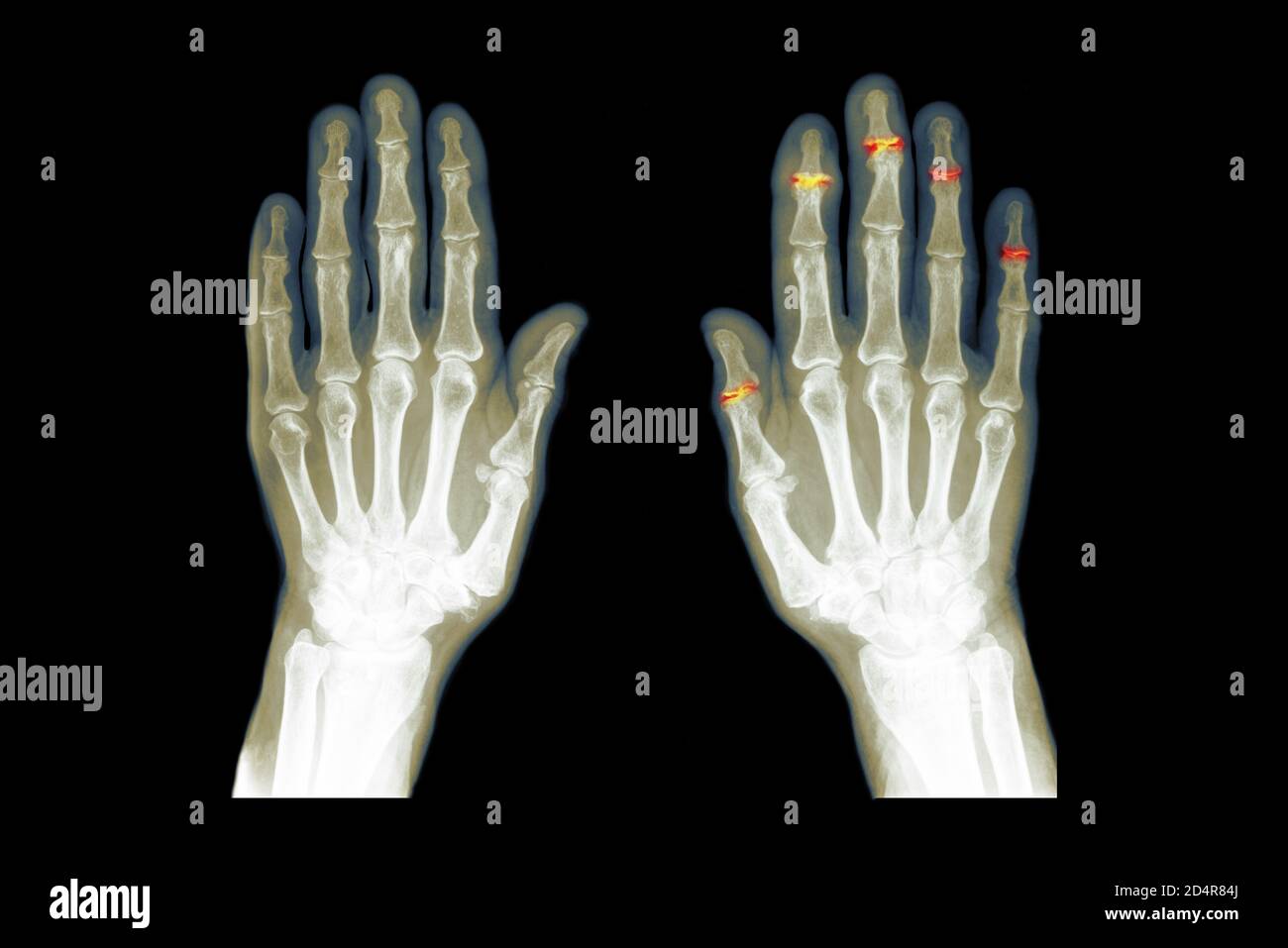 Interphalangeal joints osteoarthritis hi-res stock photography and ...
