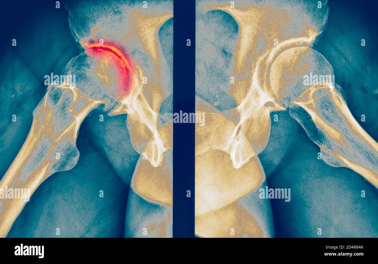 X-ray showing arthritis of the hip, arthritis is a joint disease that ...
