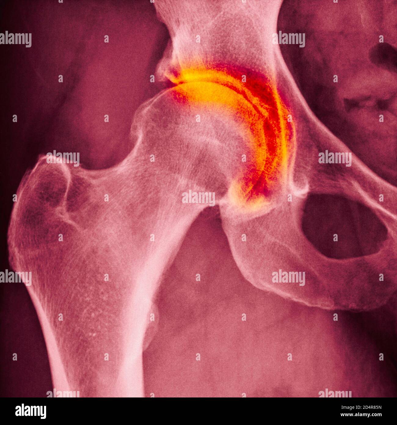 X-ray showing arthritis of the hip, arthritis is a joint disease that ...