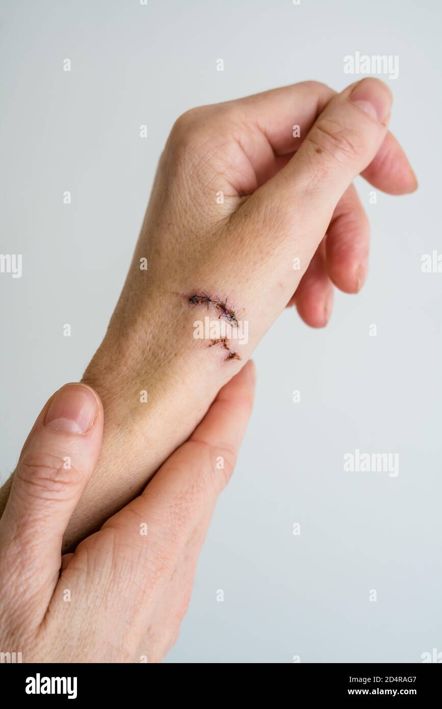 Finger Laceration Repair Time at Leo Gilruth blog