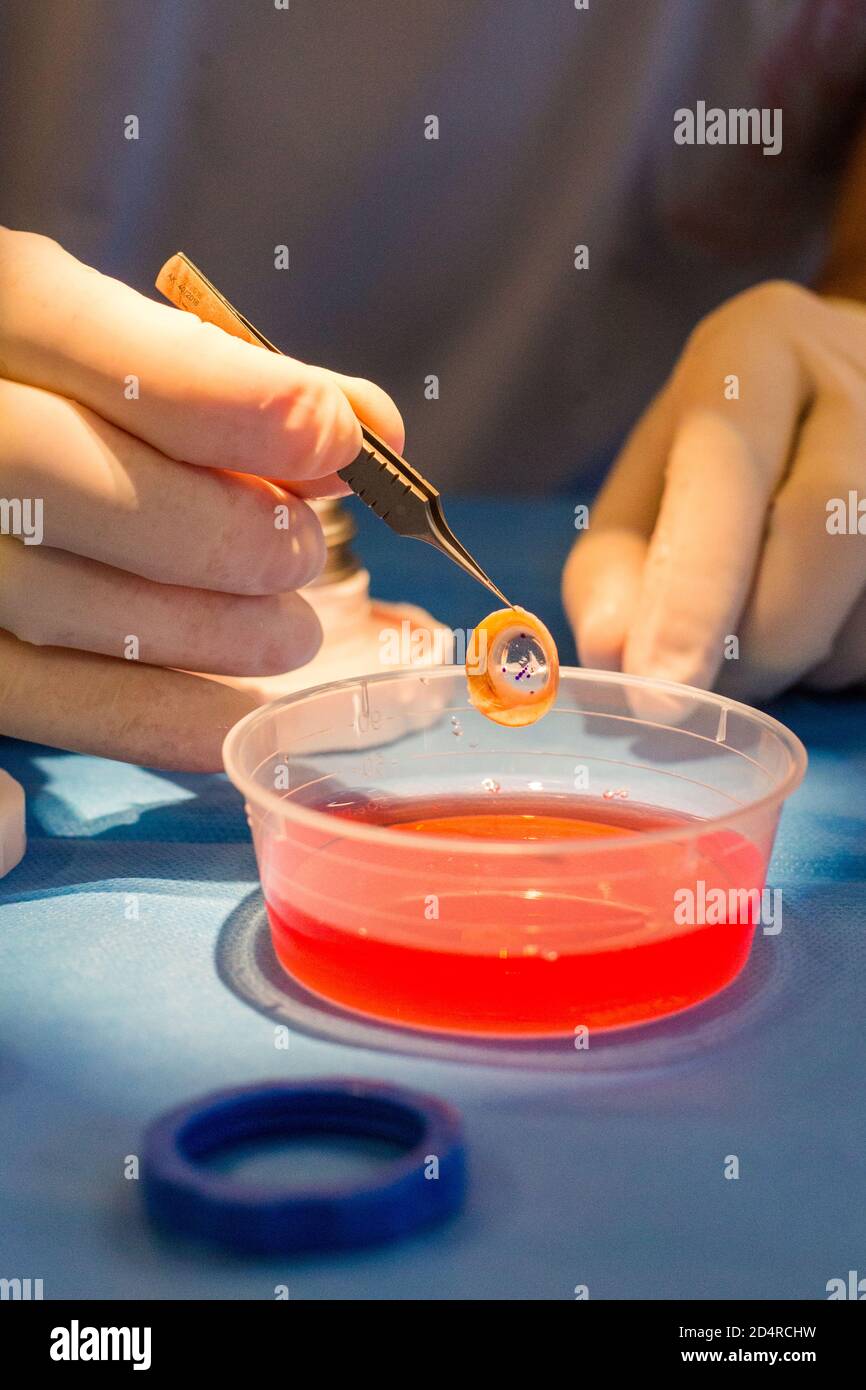 Lamellar cornea graft, Preparation of the graft,Trepanation and graft ...