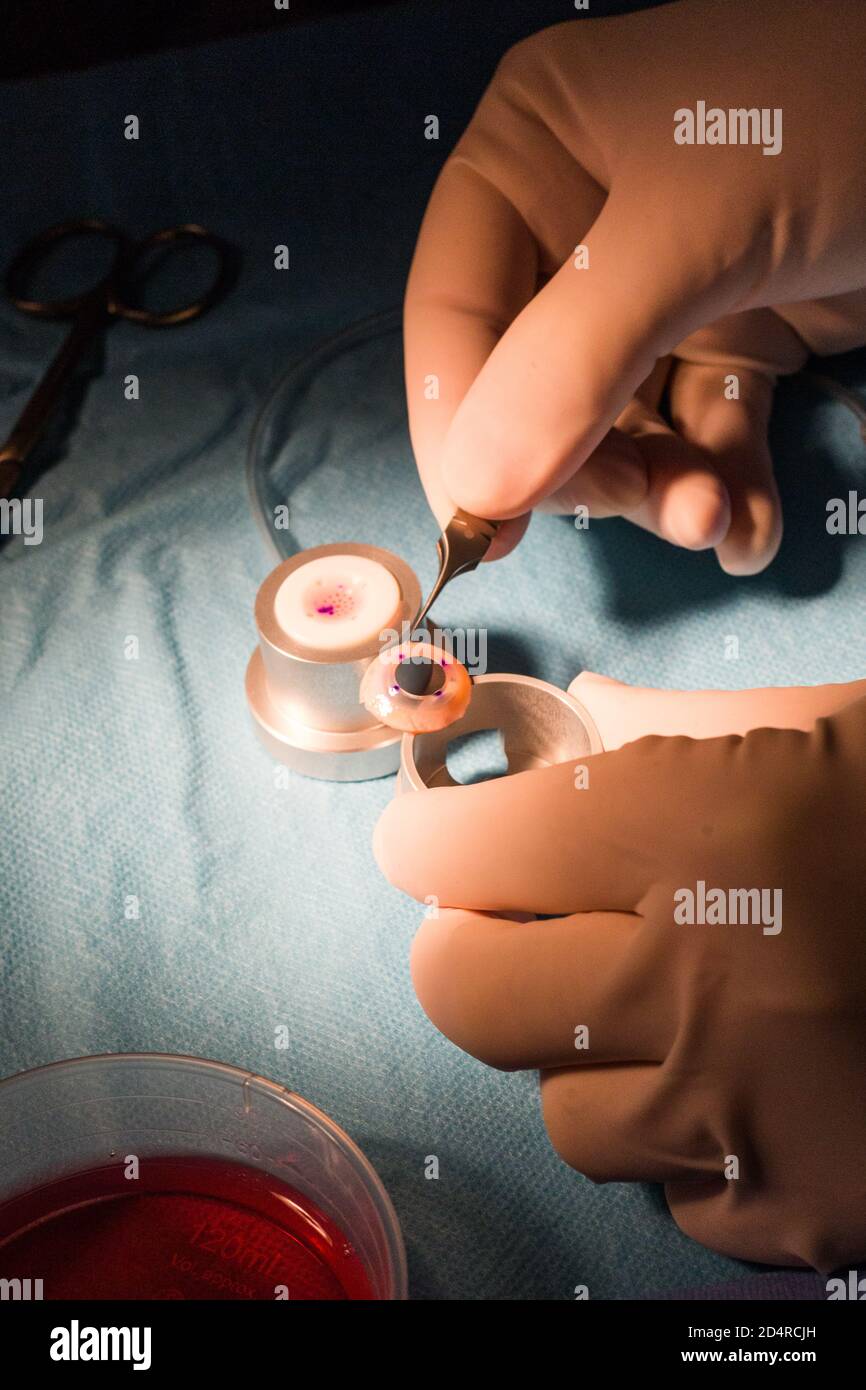 Lamellar cornea graft, Preparation of the graft,Trepanation and graft ...