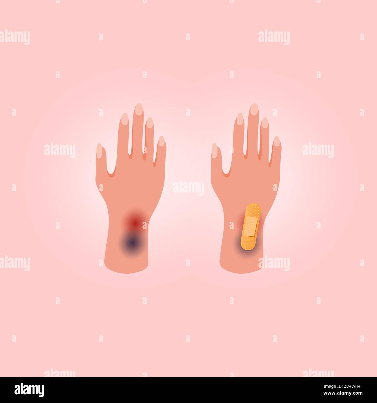 Hematoma arm Stock Vector Images - Alamy