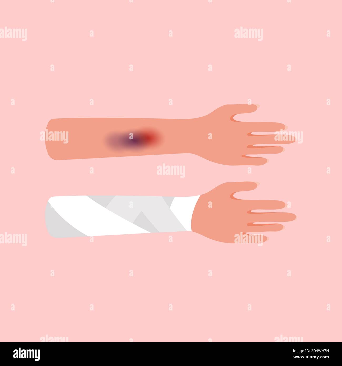 Infected bruise Stock Vector Images - Alamy