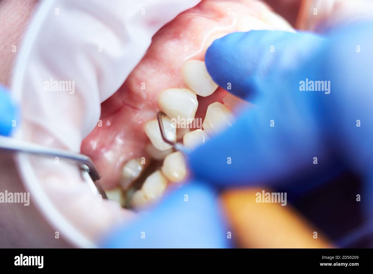 Macro close up of Human teeth with hatchet and mouth mirror. Shallow ...