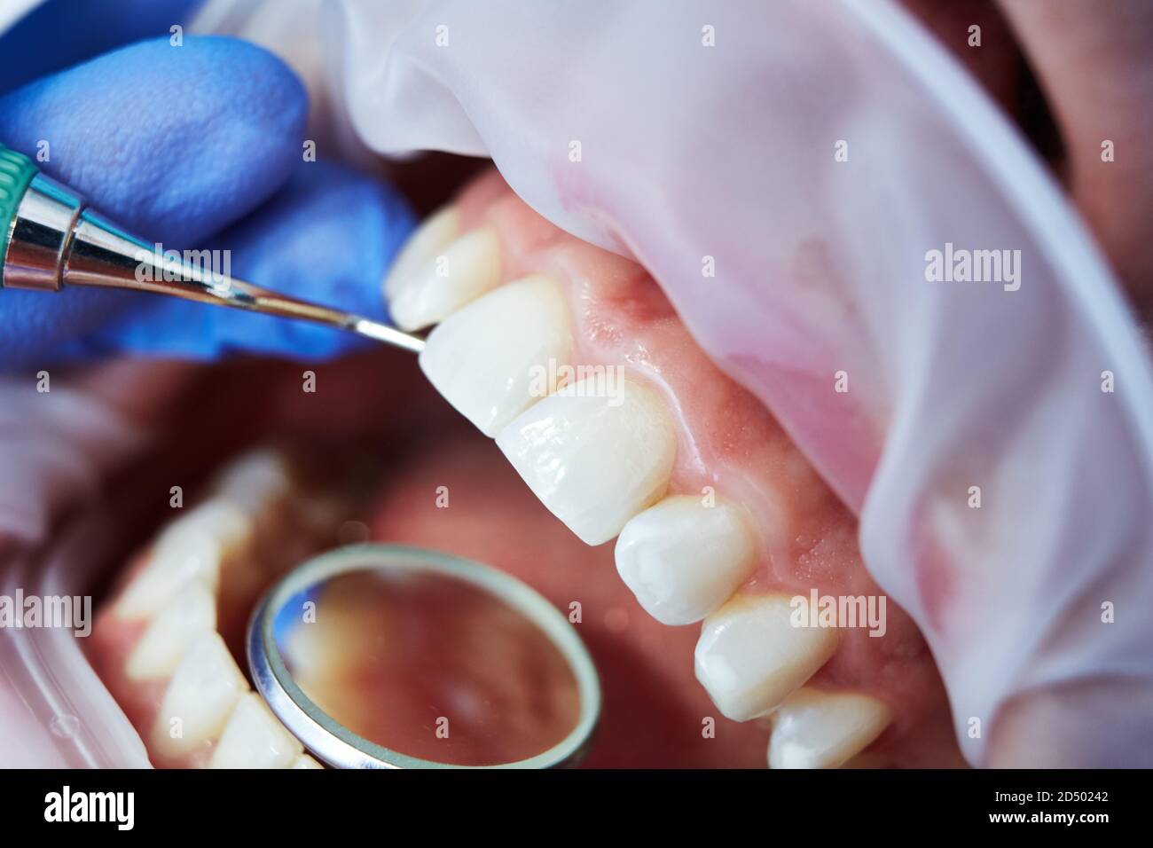 Macro close up of Human teeth with hatchet and mouth mirror. Shallow ...