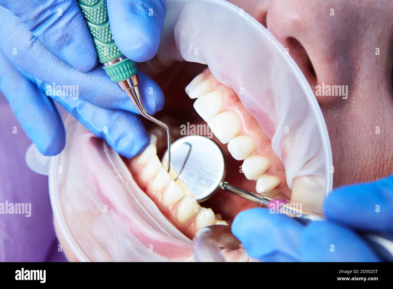 Macro close up of Human teeth with hatchet and mouth mirror. Shallow ...