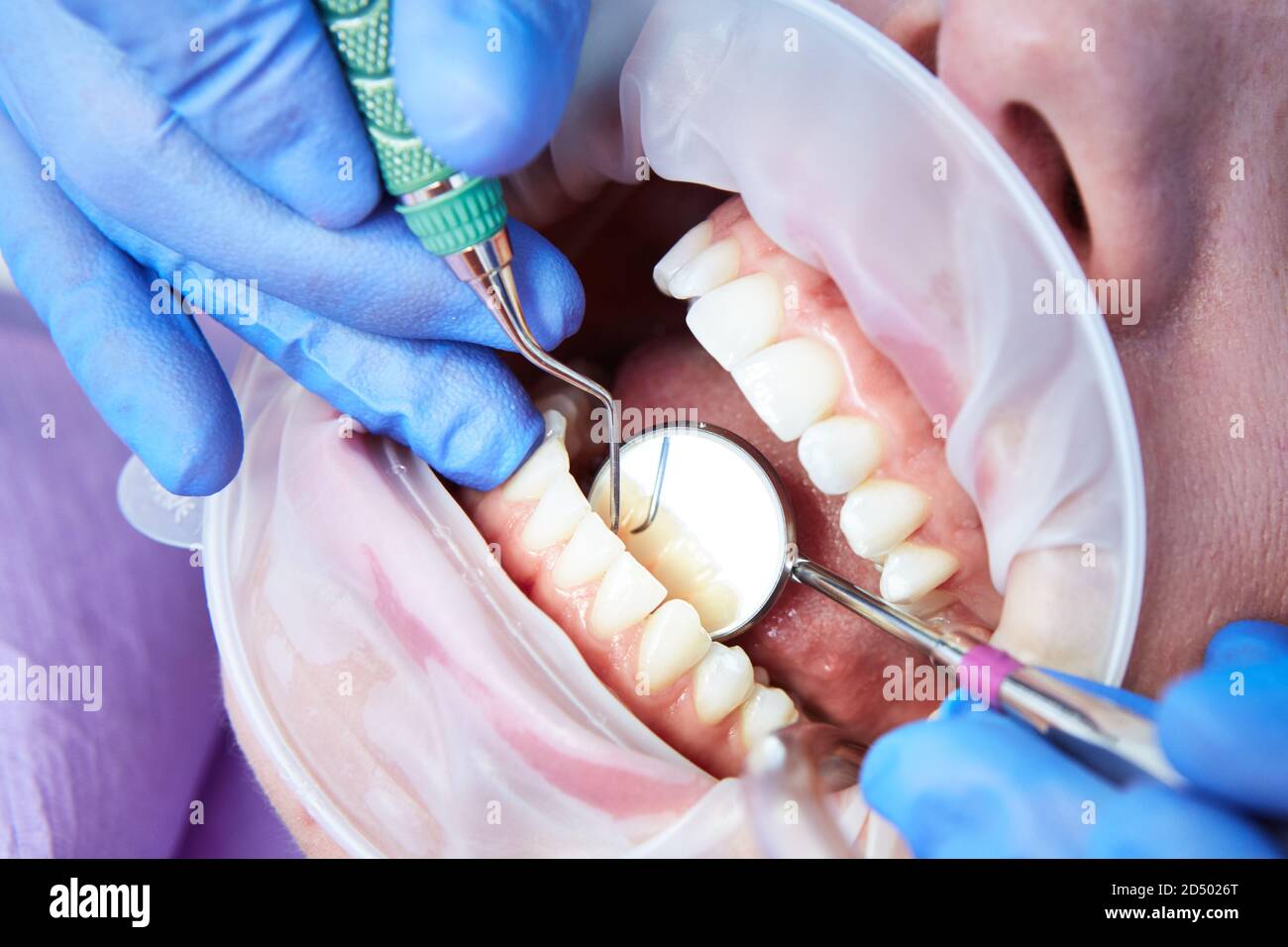 Human mouth open wide teeth hi-res stock photography and images - Alamy