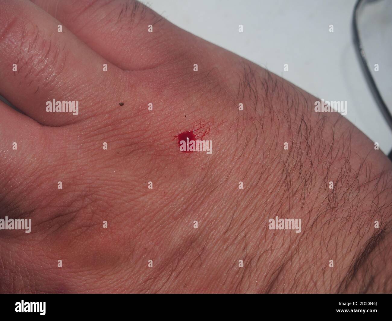 A drop of blood on the back of your hand. Small wound. Close up Stock ...
