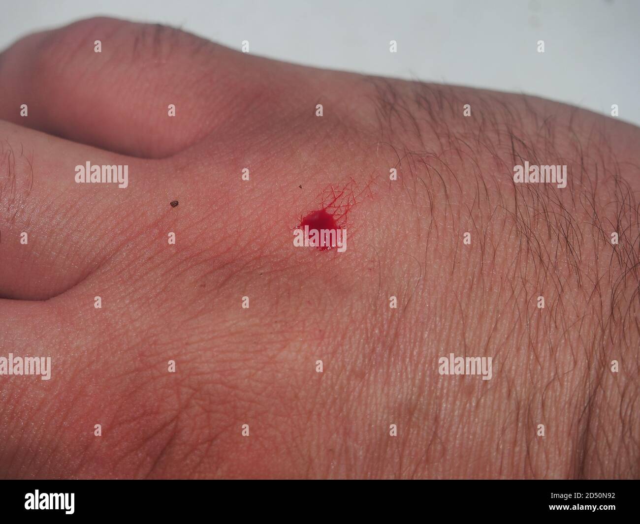 A drop of blood on the back of your hand. Small wound. Close up Stock ...