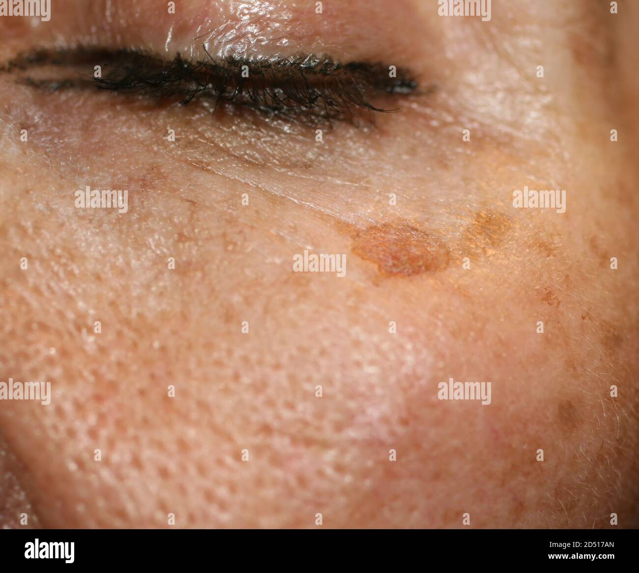 Brown spot on the skin of the face. Pigmentation on the skin Stock ...