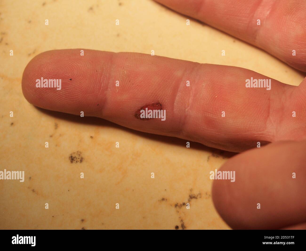 A small wound on the man's finger. The consequences of the injury ...