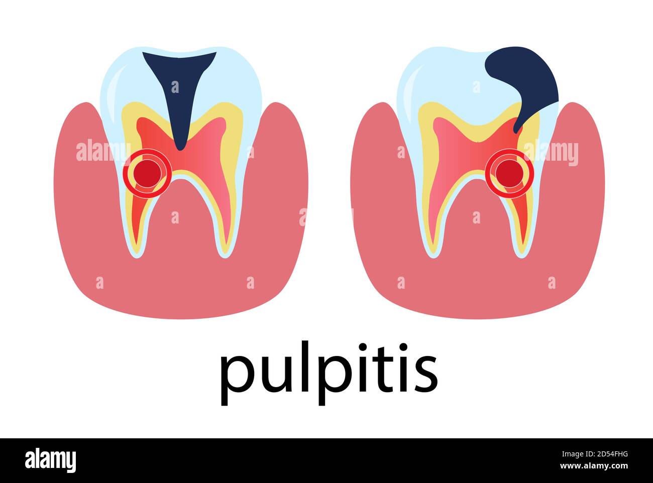 Dental treatment poster pulpitis. Human molar tooth in flat style ...