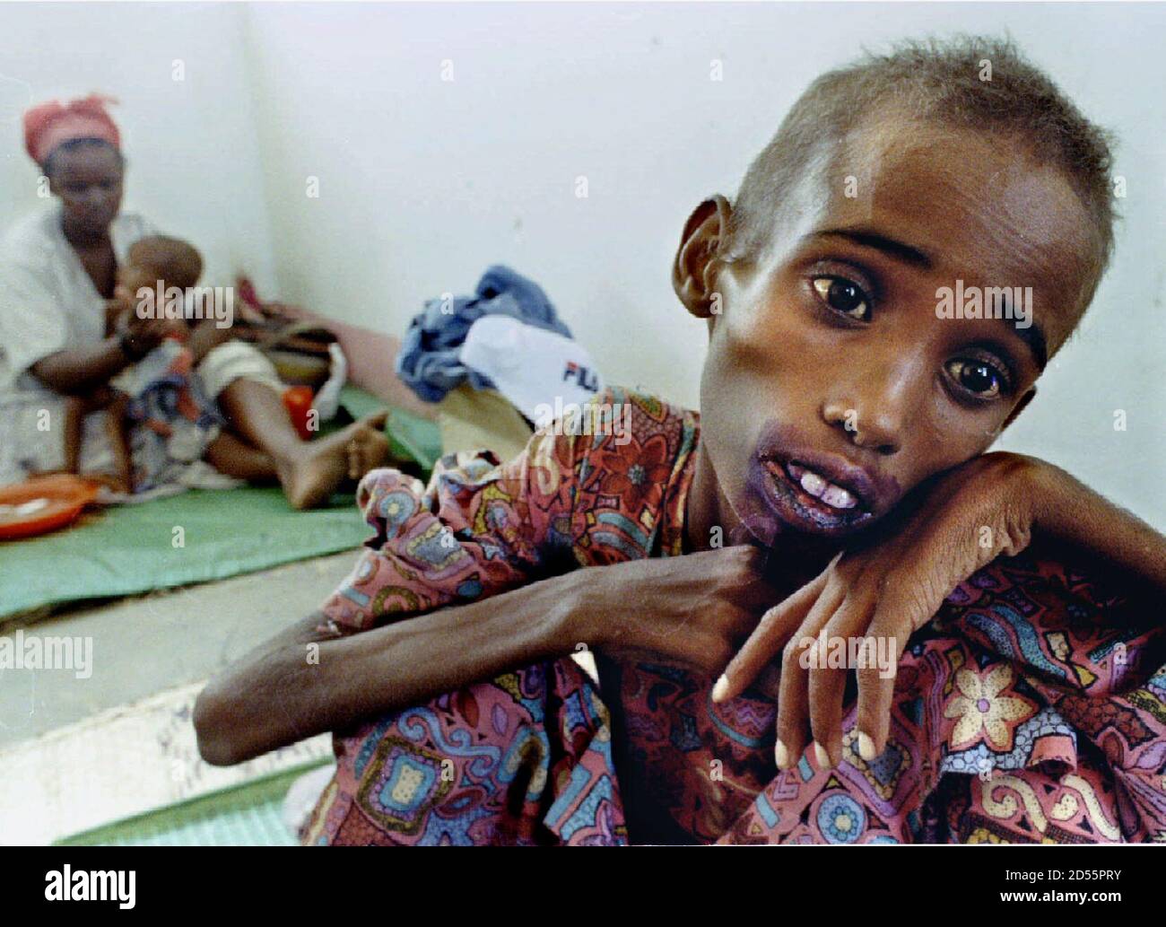 Severe malnourishment hi-res stock photography and images - Alamy