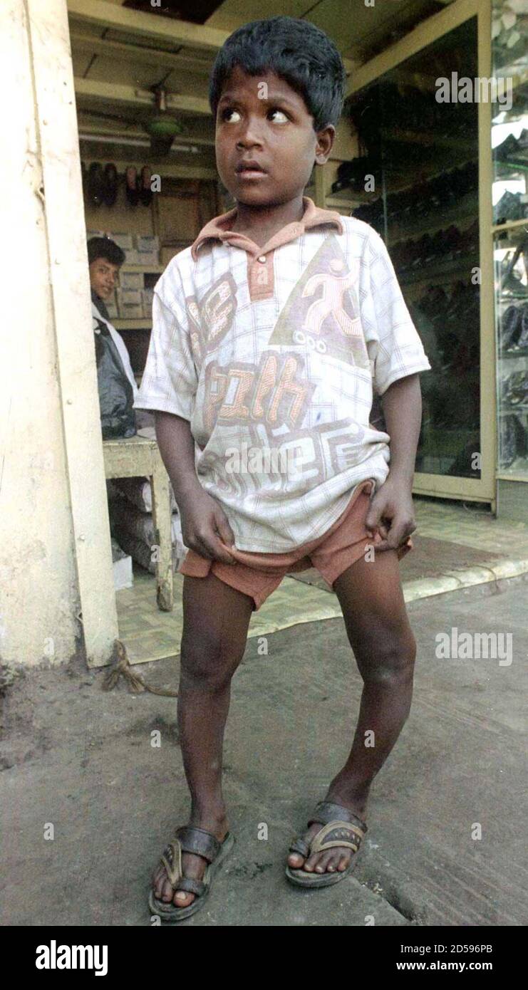 Rickets disease legs hi-res stock photography and images - Alamy