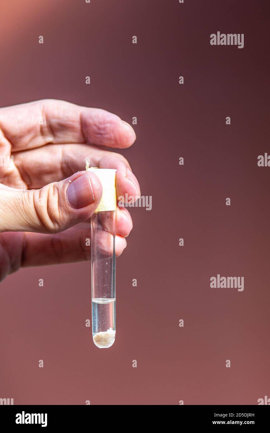 Basal cell carcinoma in skin sampling of the skin covering the back for ...