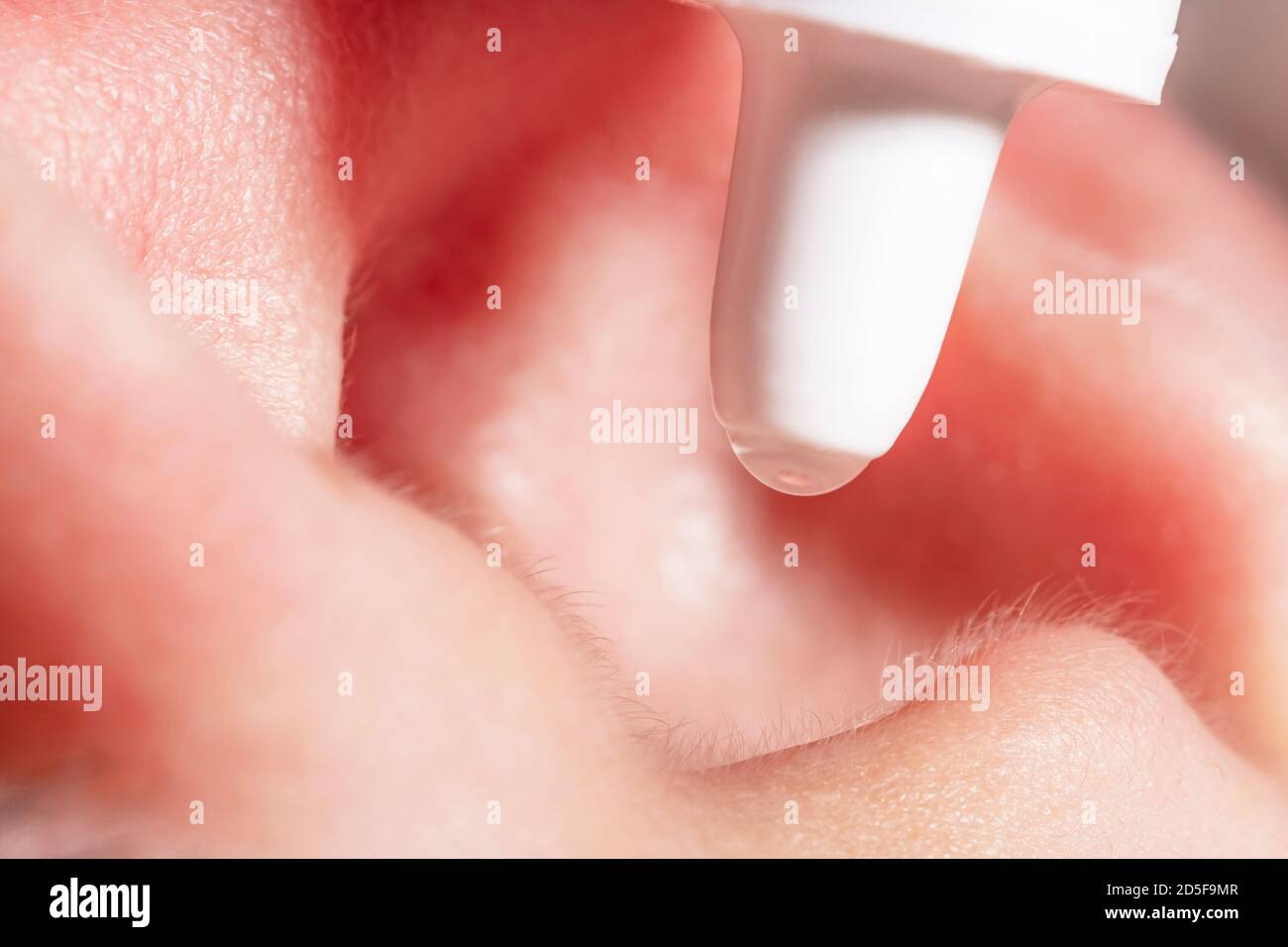 Eardrops treatment hi-res stock photography and images - Alamy