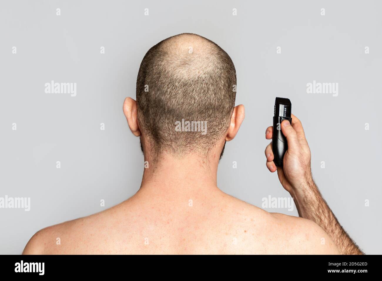 Male alopecia. A man with a receding hairline is holding an electric ...