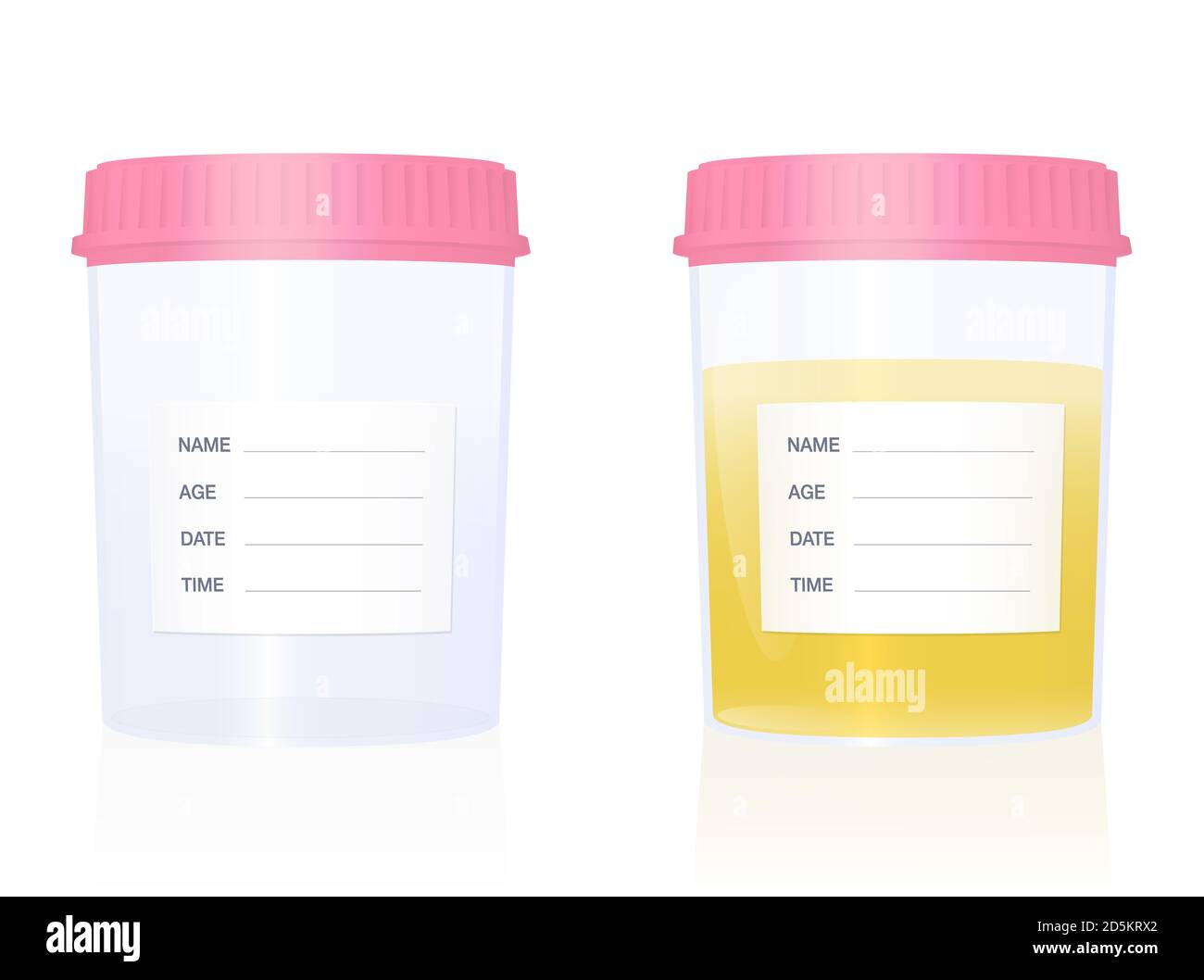 Urine sample - specimen cups for gynecological analysis - with blank ...