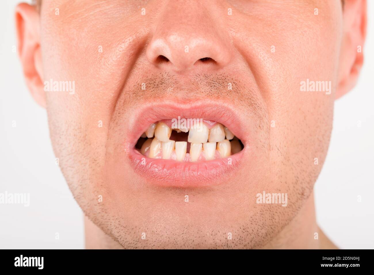 Missing teeth man hi-res stock photography and images - Alamy