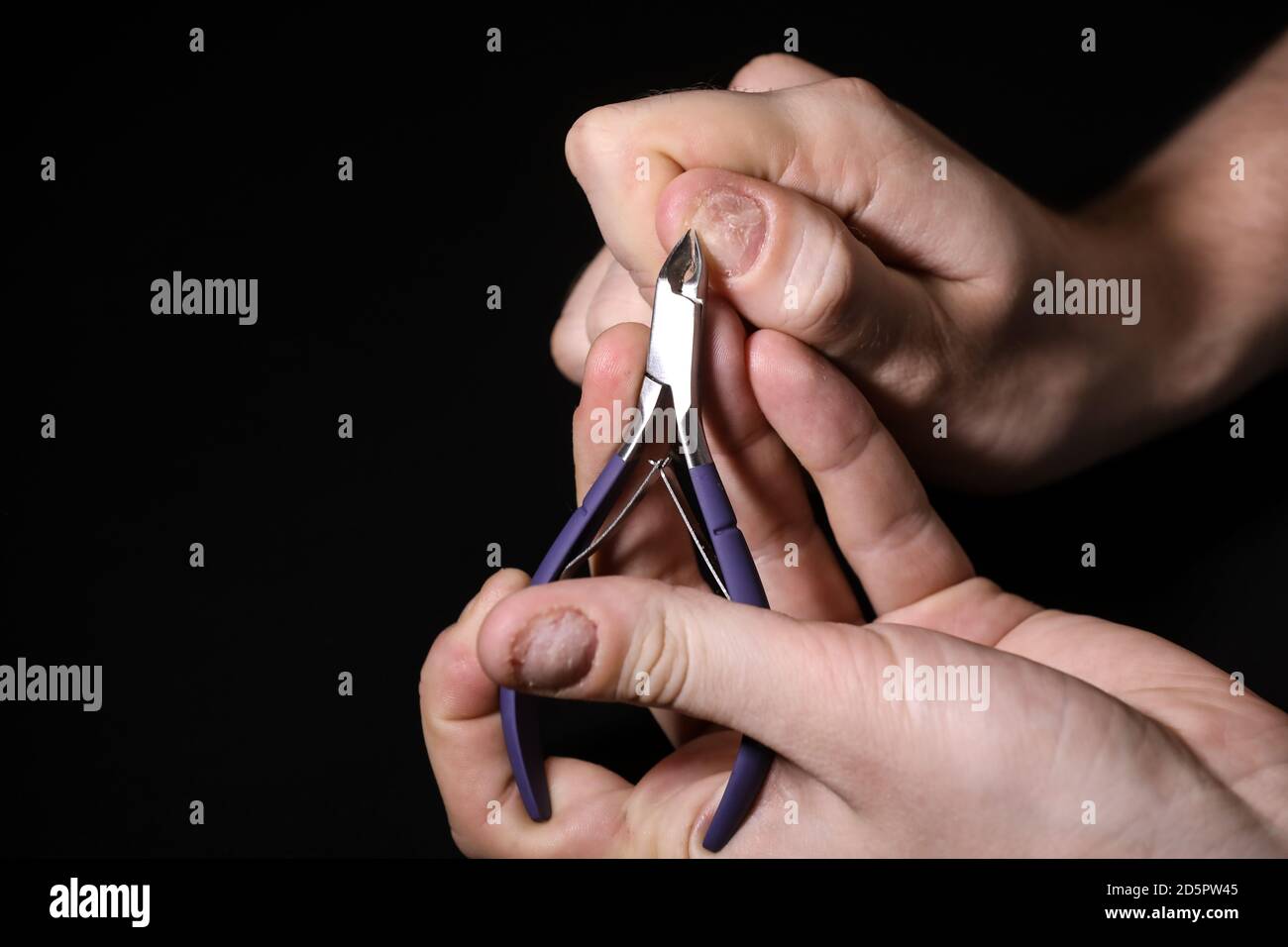 Man hand nail damage. Bitten nails. nail care. Men manicure. Nail plate ...
