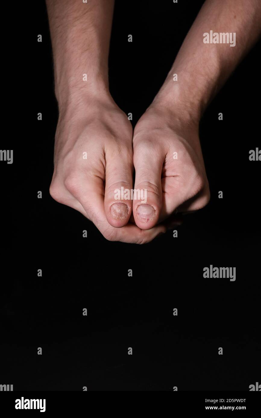 Bitten nails hi-res stock photography and images - Alamy