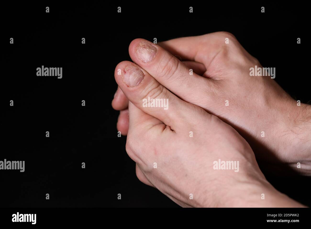 Man hand nail damage. Bitten nails. nail care. Men manicure. Nail plate ...
