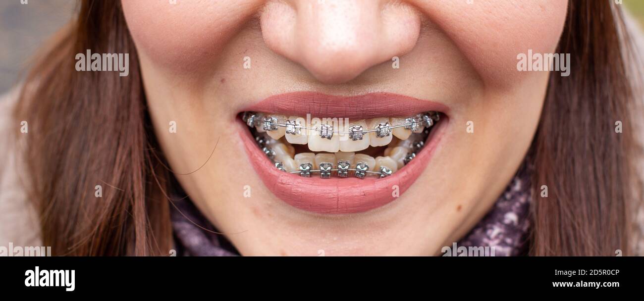 brasket system in smiling mouth, macro photo teeth, close-up lips Stock ...