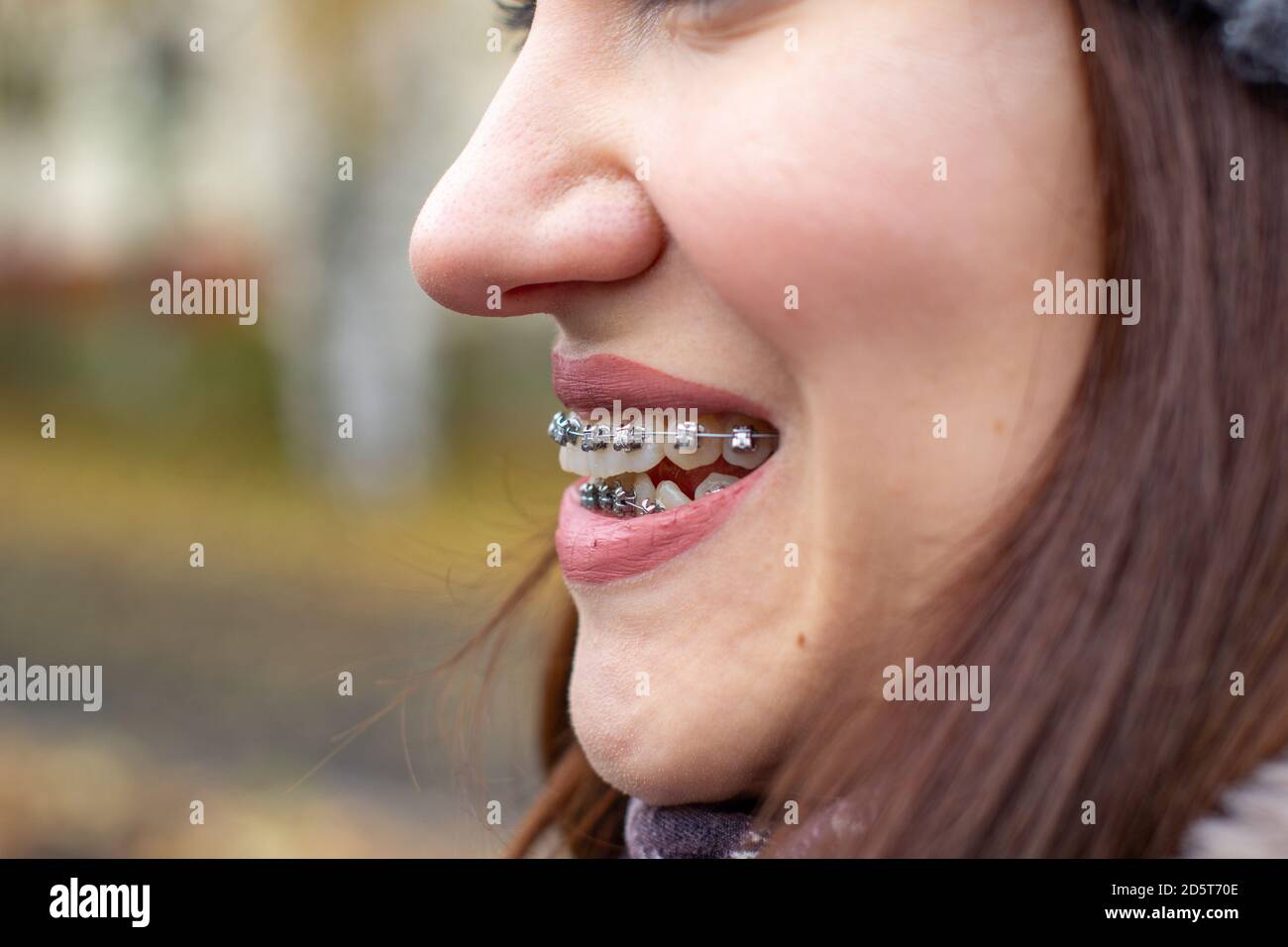 brasket system in smiling mouth, macro photo teeth, close-up lips Stock ...