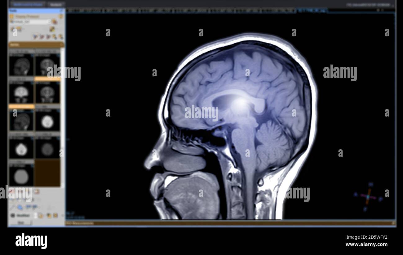 MRI of the brain Sagittal T1 for detect a variety of conditions of the ...