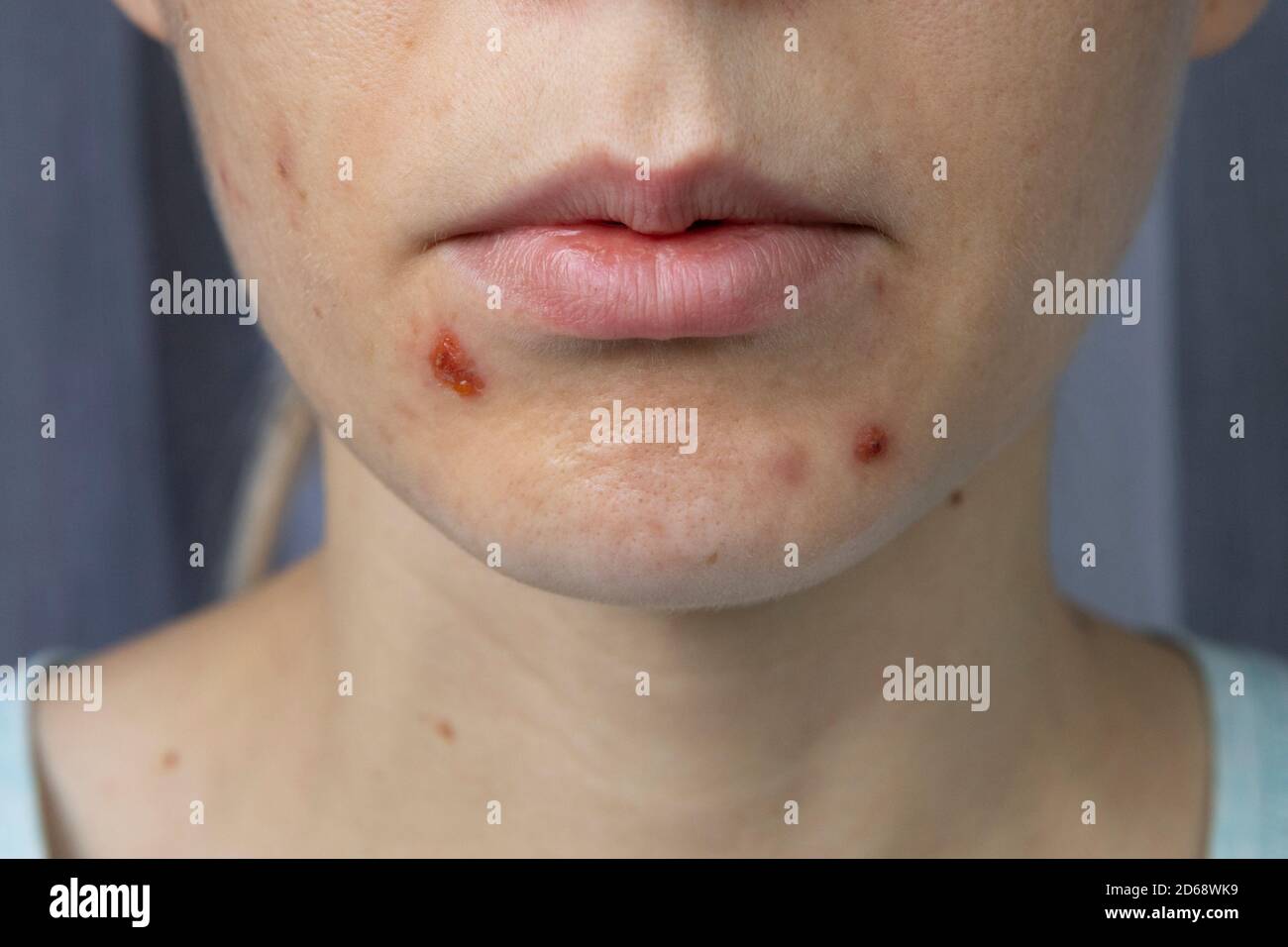 Young woman has skin problems. Girl with pimples on her face Stock ...