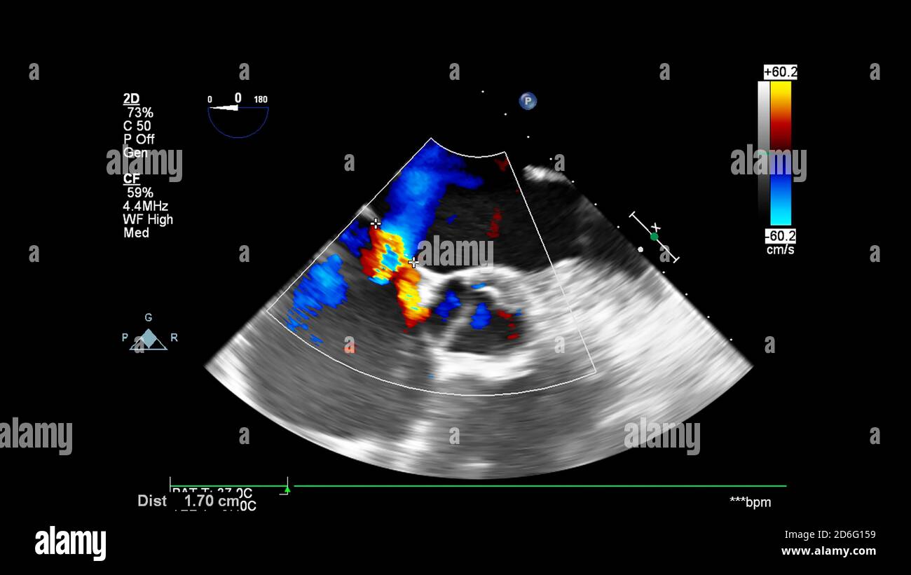 Image of the heart during transesophageal ultrasound with Doppler mode ...