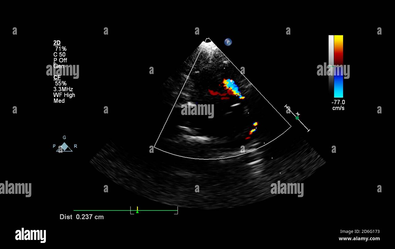 Image of the heart during transesophageal ultrasound with Doppler mode ...