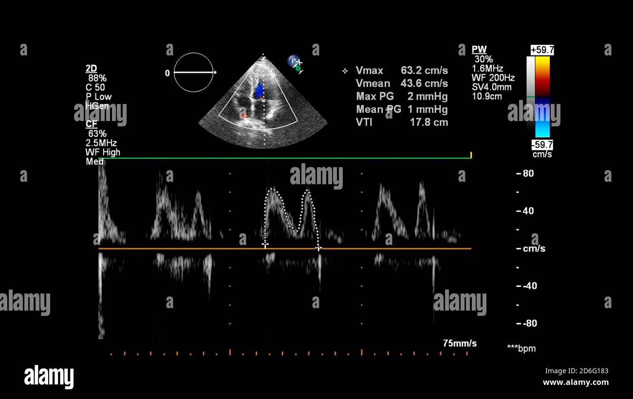 Image of the heart during transesophageal ultrasound with Doppler mode ...