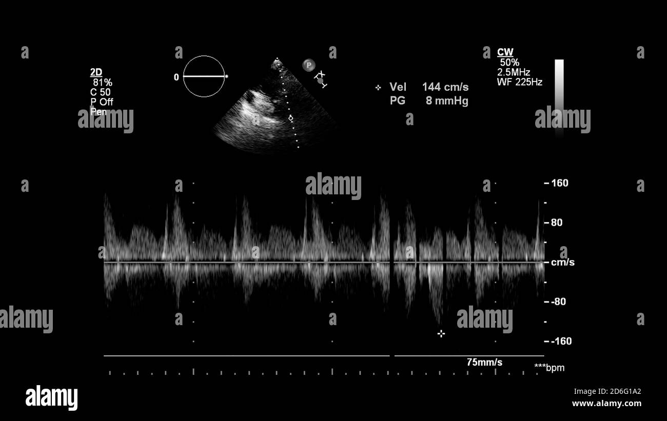 Image of the heart in gray-scale mode during transesophageal ultrasound ...
