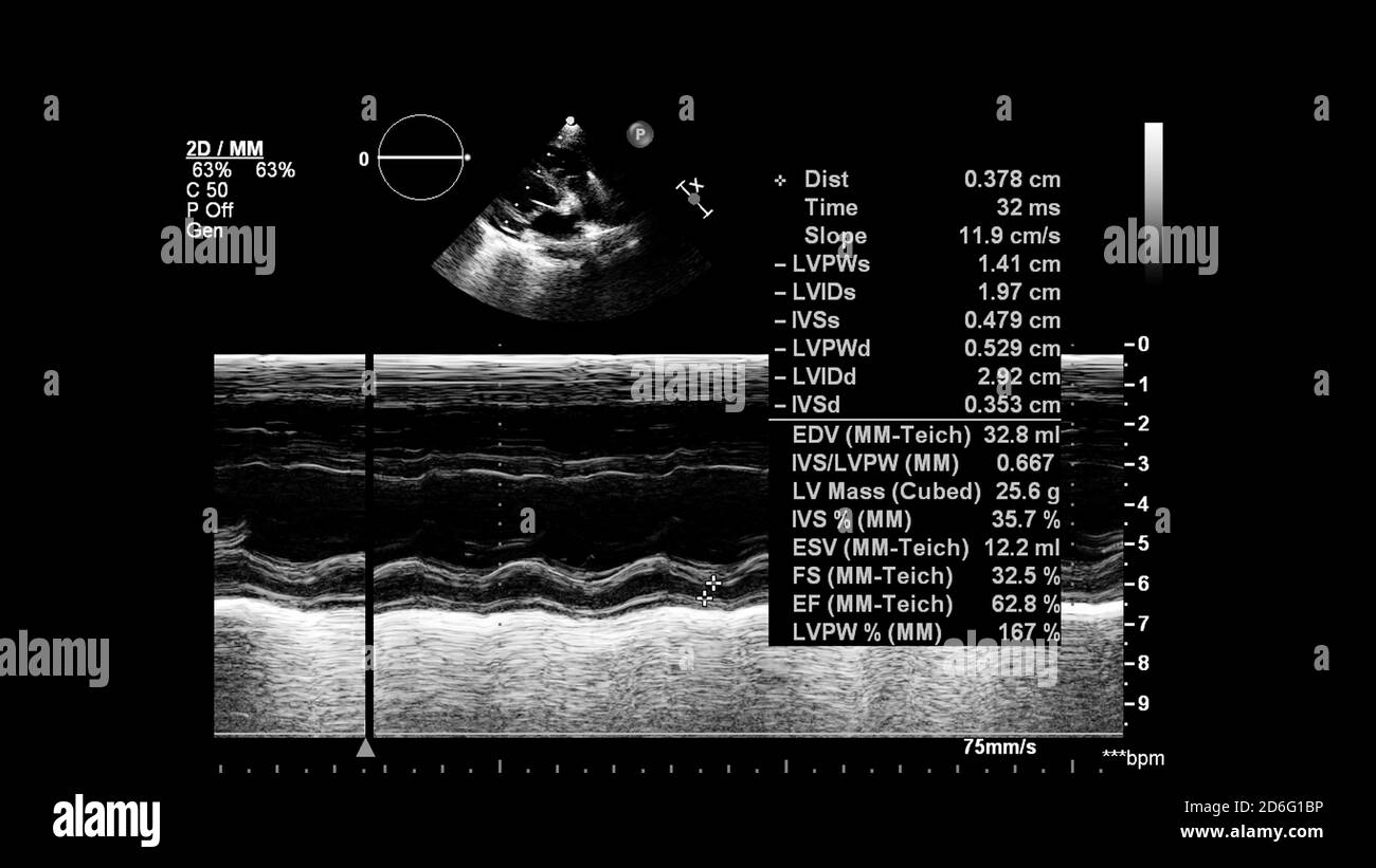 Image of the heart in gray-scale mode during transesophageal ultrasound ...