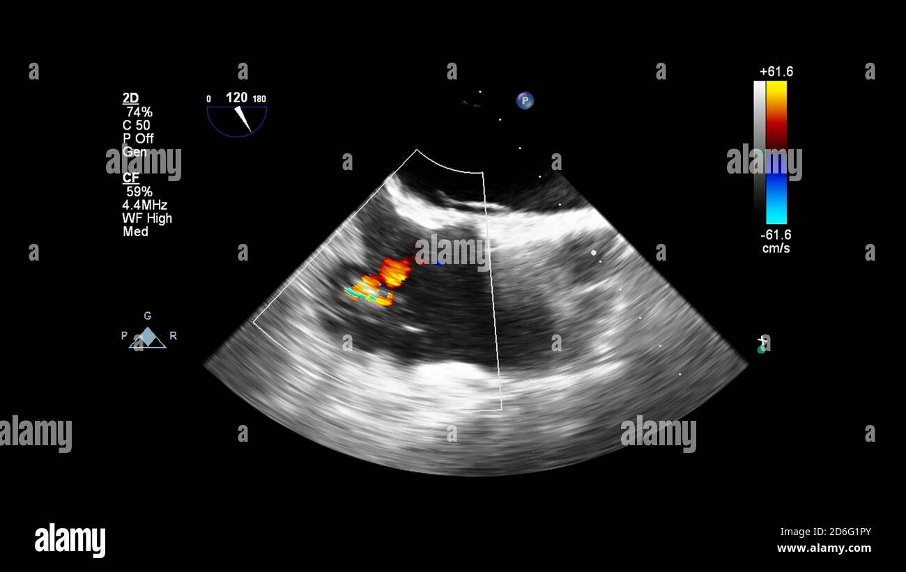 Image of the heart during transesophageal ultrasound with Doppler mode ...