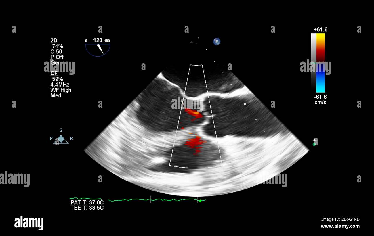 Image of the heart during transesophageal ultrasound with Doppler mode ...