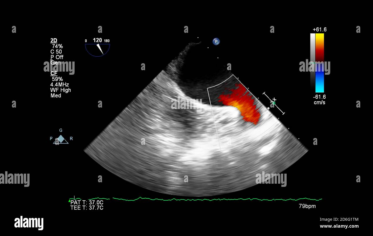 Image of the heart during transesophageal ultrasound with Doppler mode ...