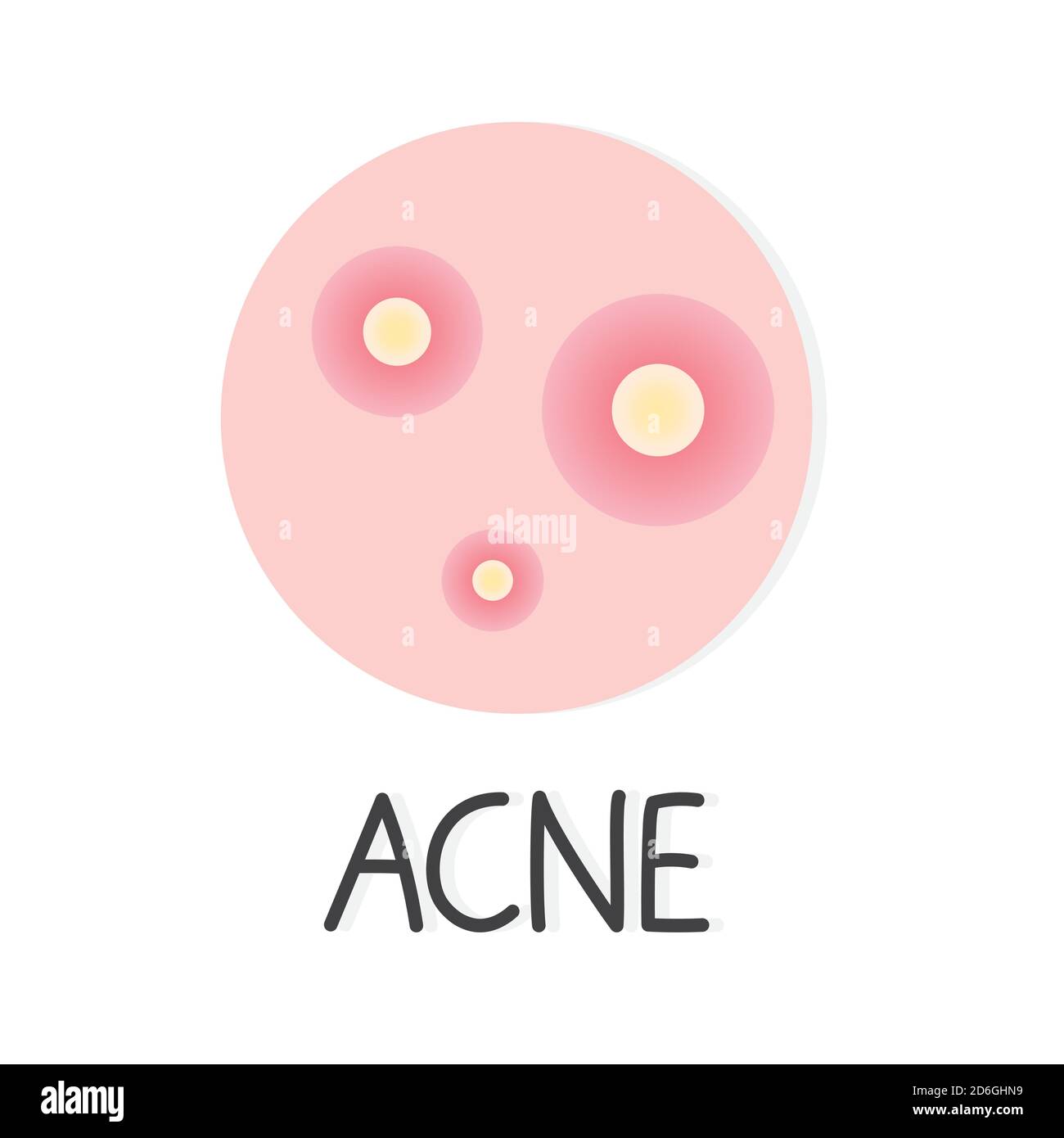 Acne Vector Vectors High Resolution Stock Photography and Images - Alamy