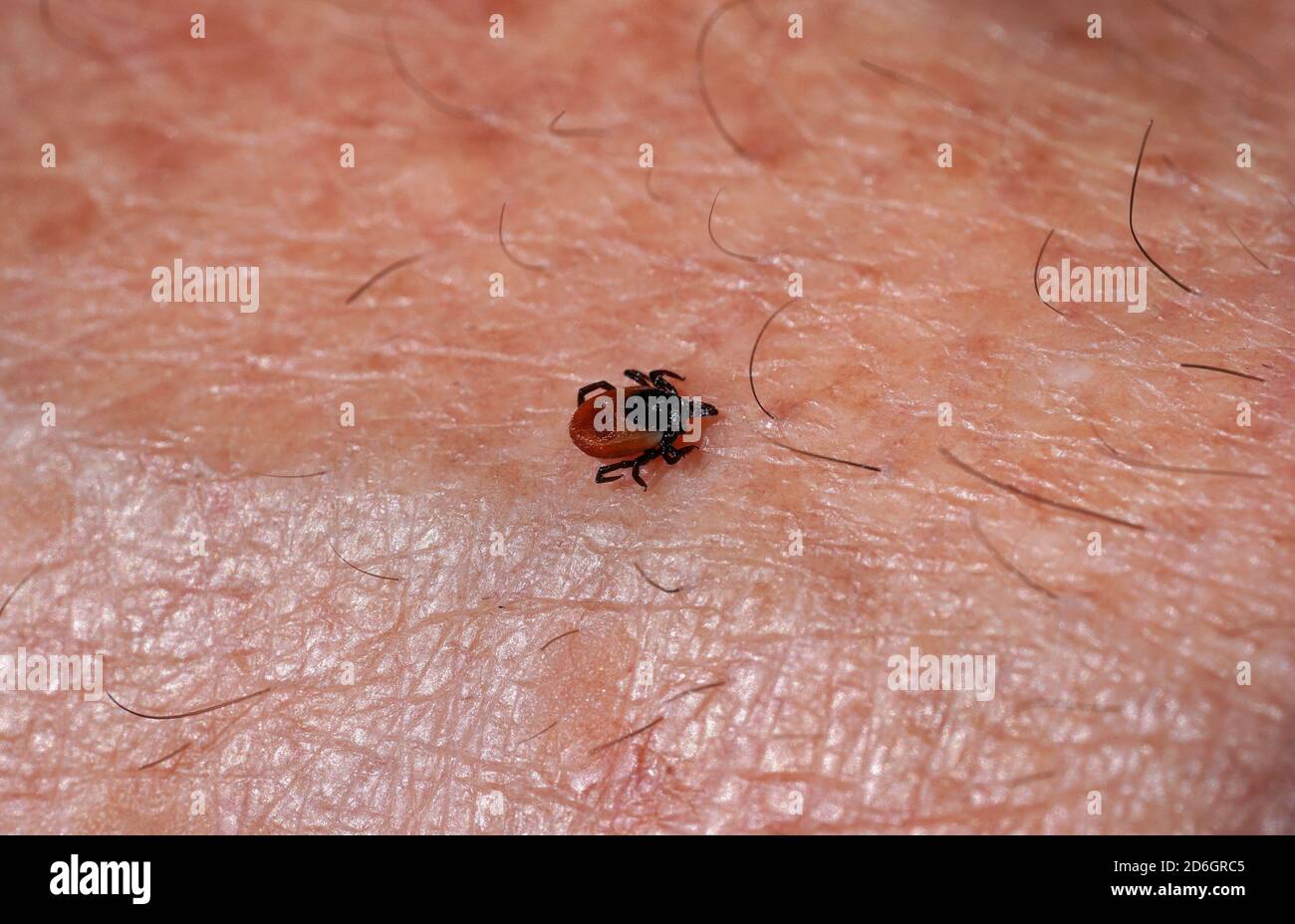 Small tick Ixodes ricinus crawling on human skin Stock Photo - Alamy