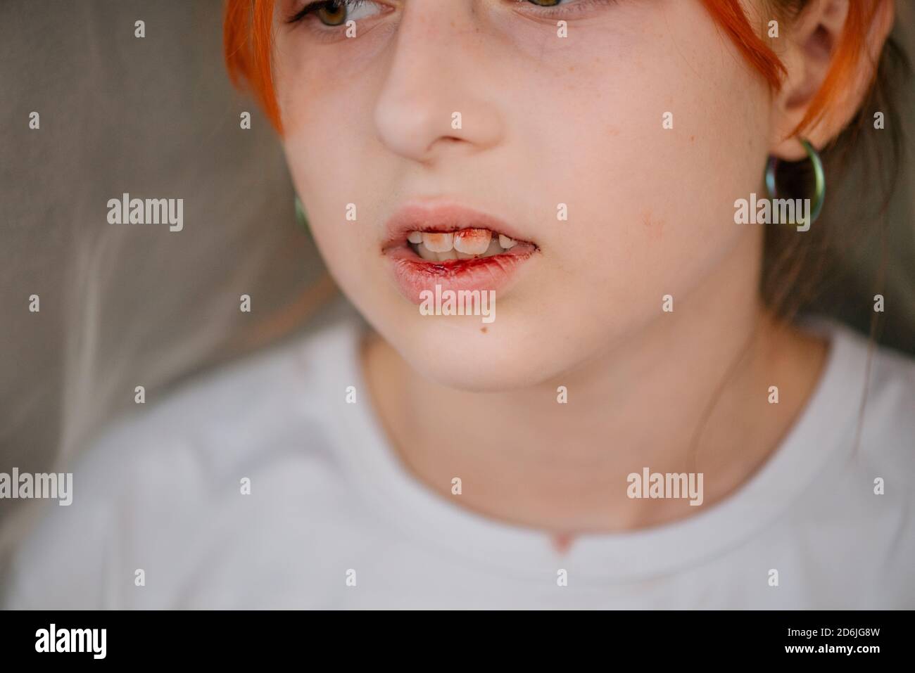 little girl with a broken lip. Girl with a broken lip Stock Photo - Alamy