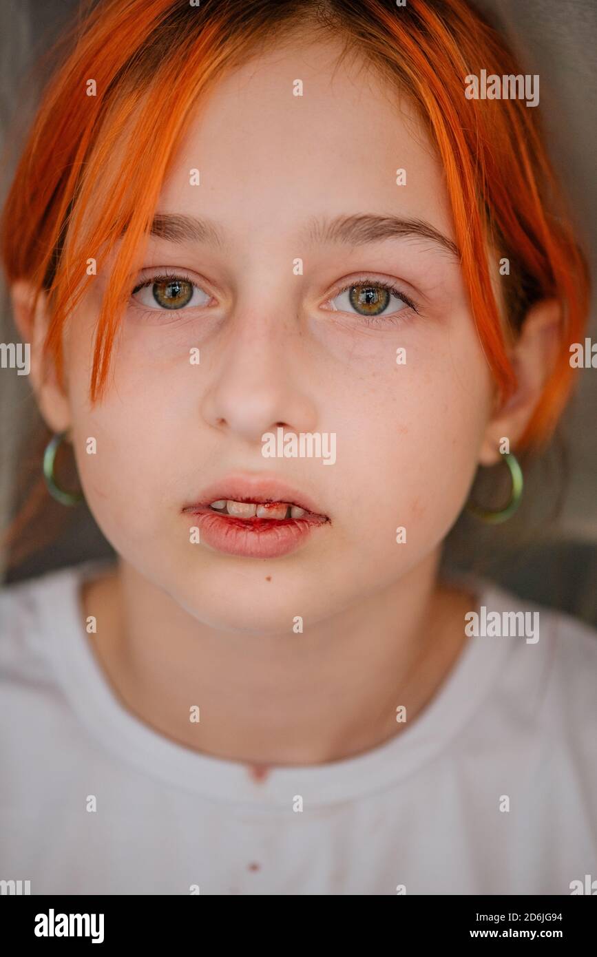 little girl with a broken lip. Girl with a broken lip Stock Photo - Alamy