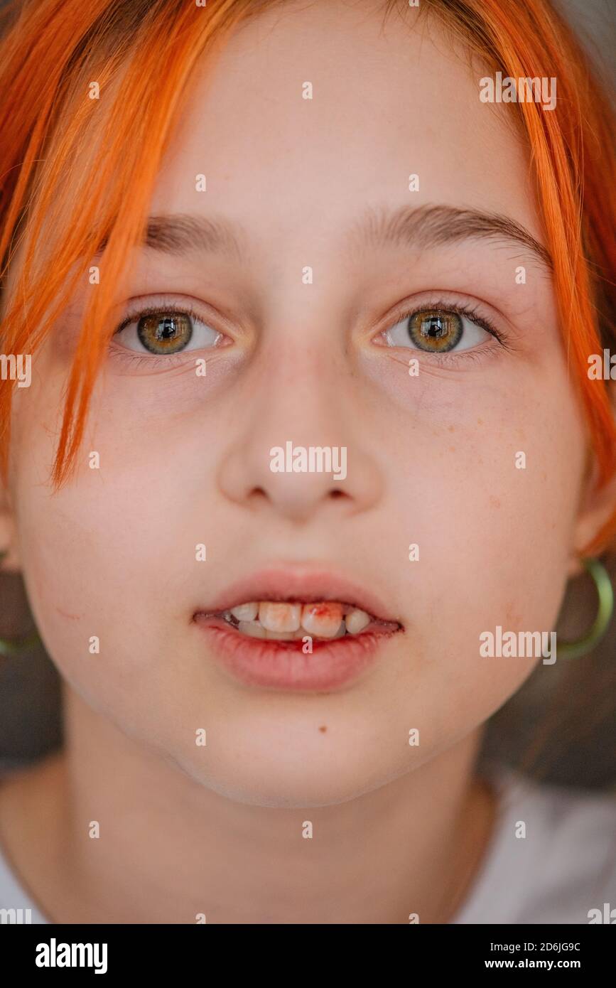 little girl with a broken lip. Girl with a broken lip Stock Photo - Alamy
