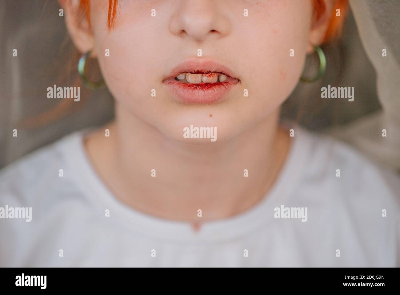 little girl with a broken lip. Girl with a broken lip Stock Photo - Alamy